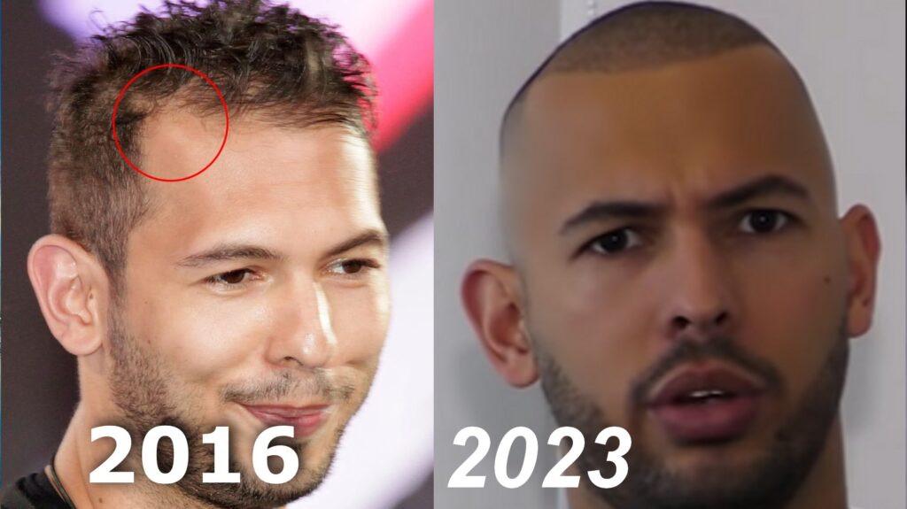 Andrew Tate’s Hair Transplant Journey: A Story of Renewed Confidence