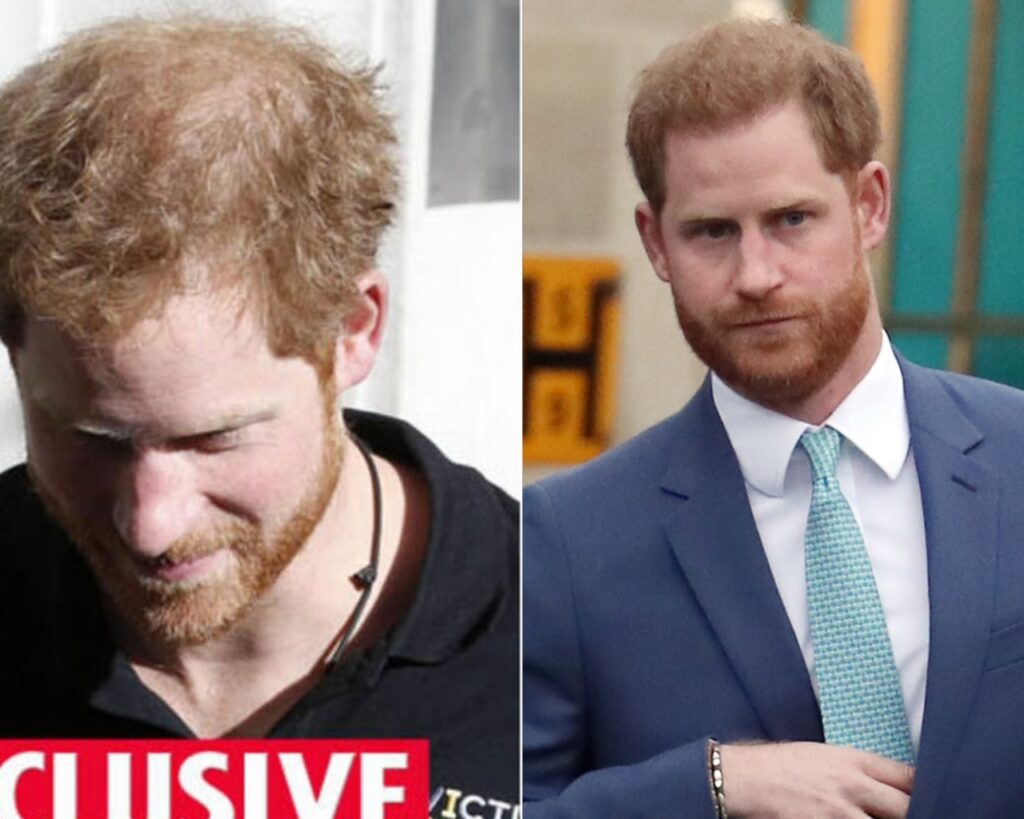 A Look into Prince Harry’s Hair Journey! A Royal Hair Transplant